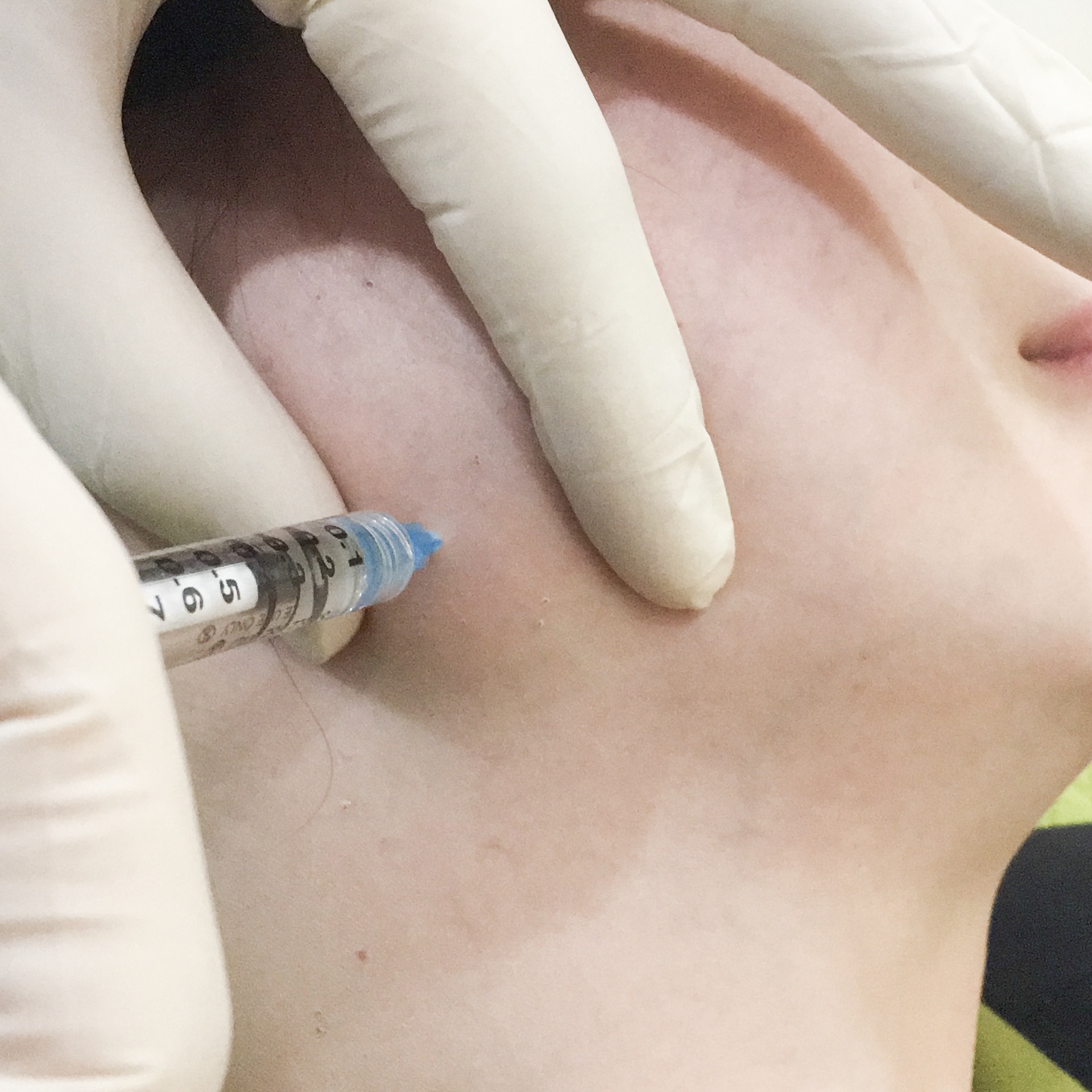 Mesotherapy Treatment | Revix Clinic
