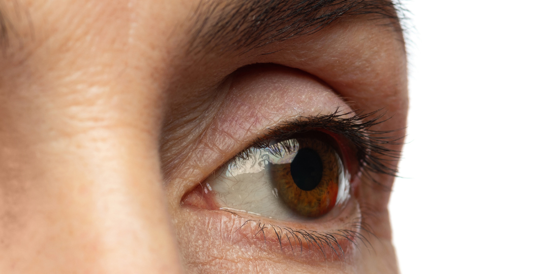 From Tired to Vibrant: Quick Fixes for Eye Bags - Revix Clinic