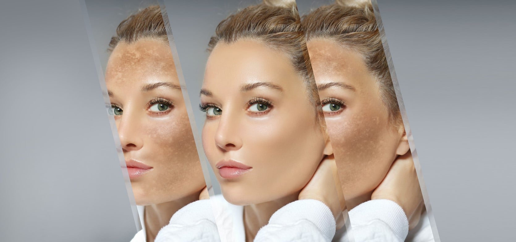 Melasma Myths Debunked! - Revix Clinic