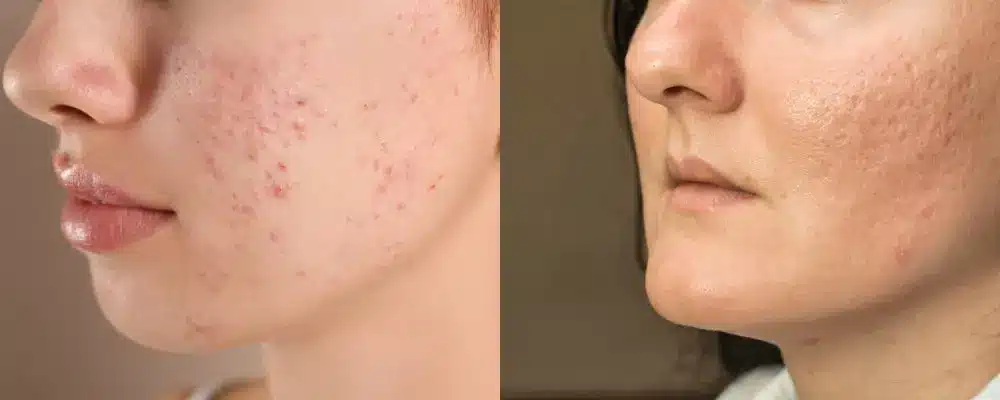 What Are Acne Scars and How Do They Form?