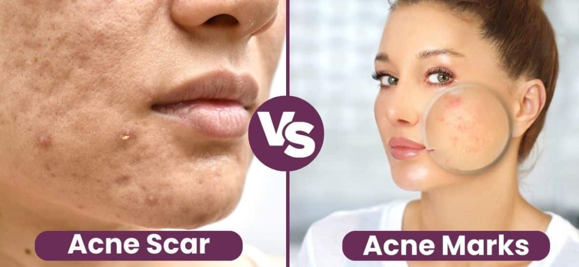 Difference Between Acne Marks vs Acne Scars